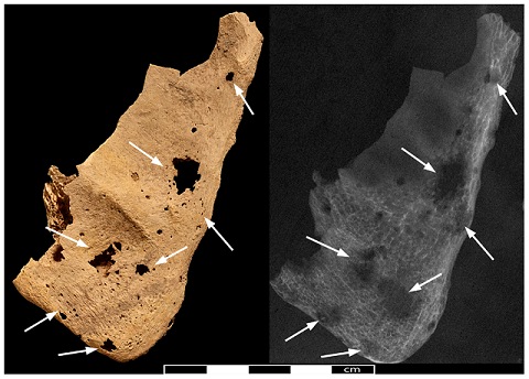 Hallado un cáncer de más de 3.000 años - RT